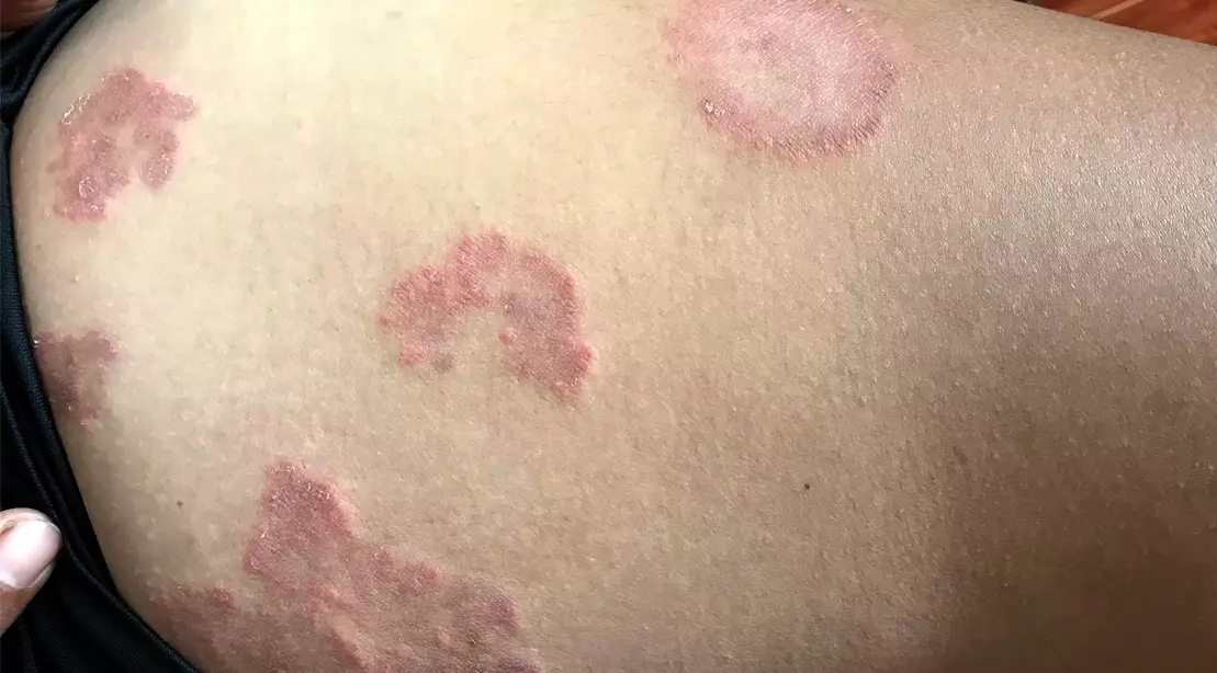 Ring-Worm-Infection-Thigh-Skin